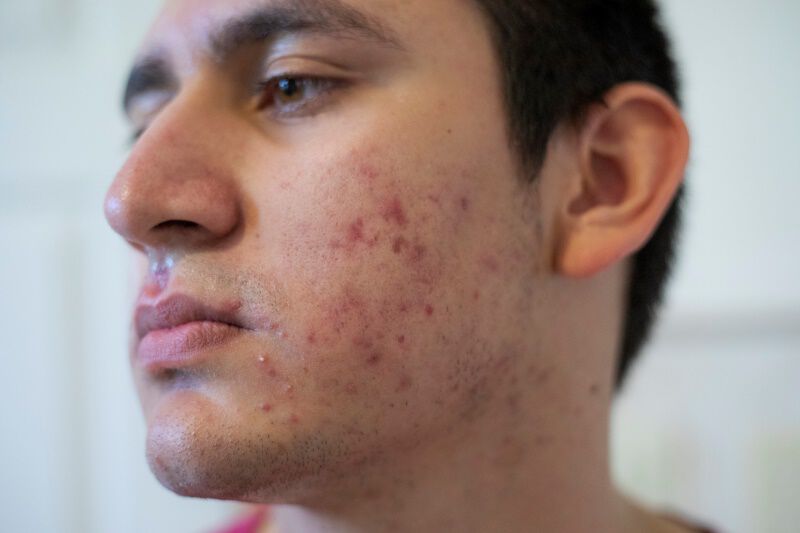 pimples on face indicates men